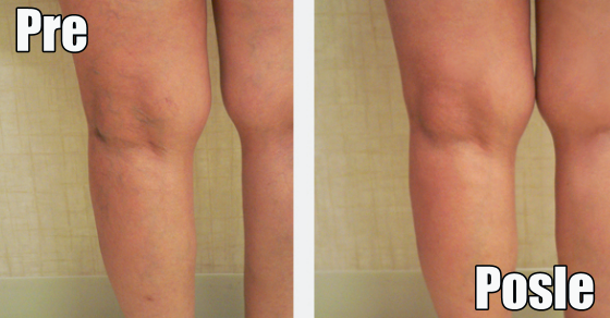 Kako lečiti proširene vene na nogama | simptomi | ishrana