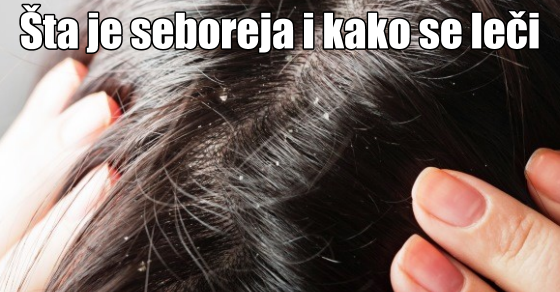 Seboreja vlasišta i perutanje kože glave | simptomi | lečenje