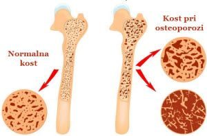 Najbolji prirodni lekovi za osteoporozu i jačanje kostiju